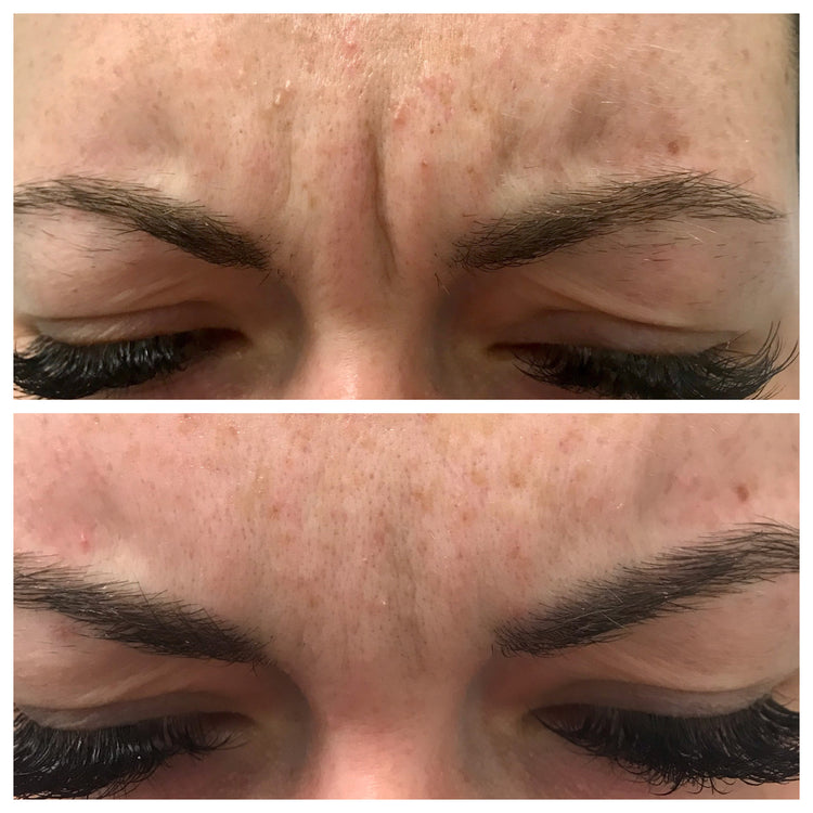 Wrinkle Reduction – Bella & Co. Med Spa Lake Norman